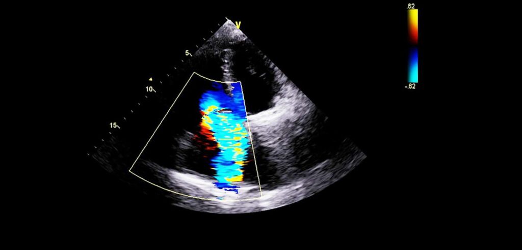 Color Doppler In Chembur - Medcare Diagnostics