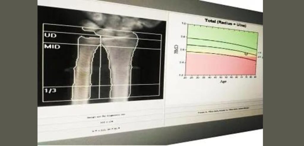3D Bone Densitometry In Chembur - Medcare Diagnostics